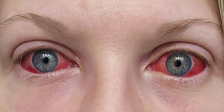 Cocaine Eyes: How Does Cocaine Affect Eyes? | White Oak Recovery Center